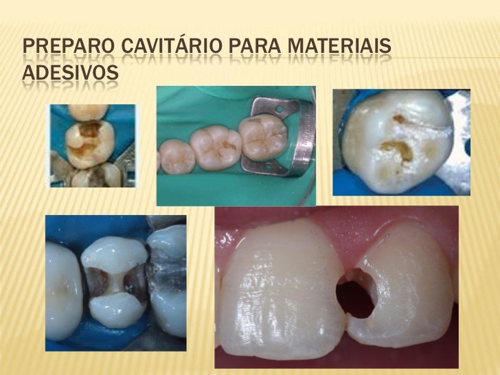 Nomenclatura e Classificação das Cavidades