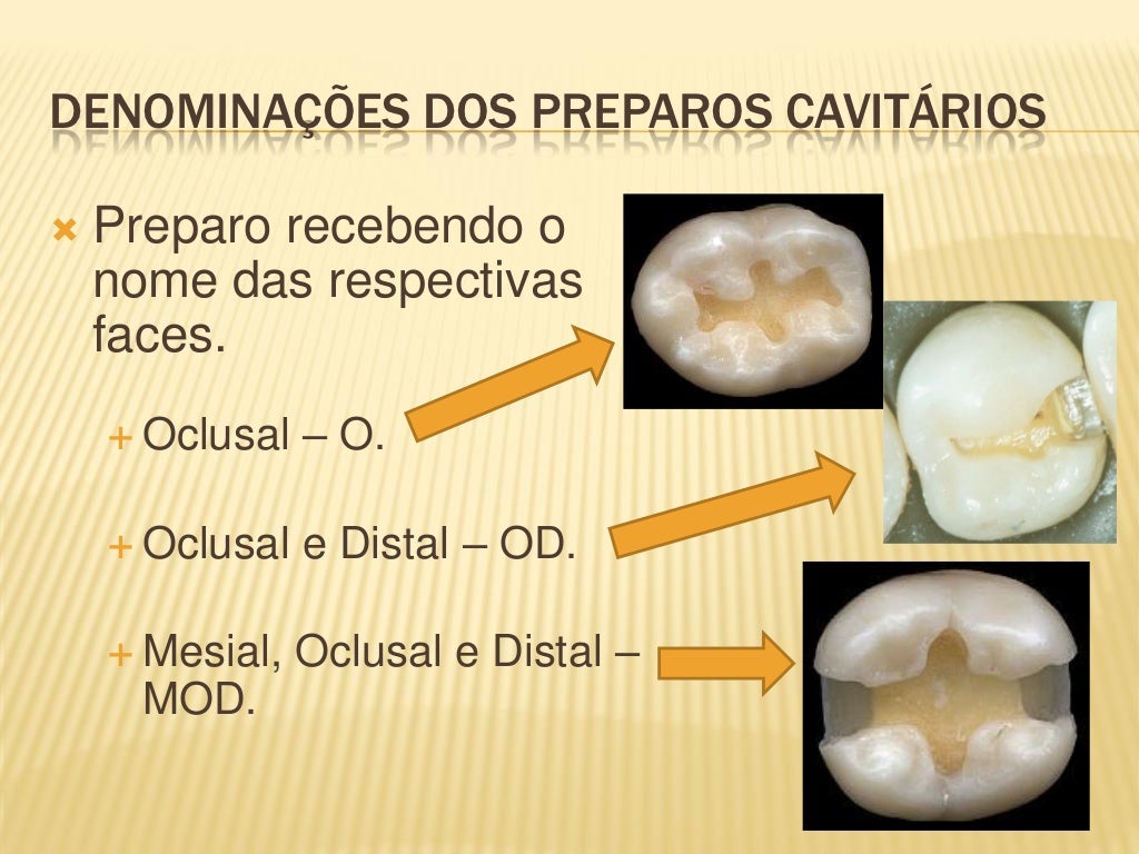 Nomenclatura E Classificação Das Cavidades - RETOEDU