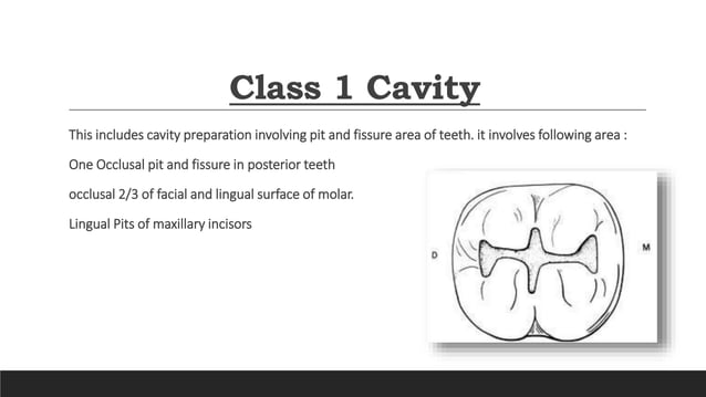 Nomenclature in operative dentistry | PPTX | Dental Health | Diseases ...