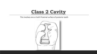 Nomenclature in operative dentistry | PPTX