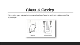 Nomenclature in operative dentistry | PPTX | Dental Health | Diseases ...
