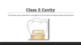 Nomenclature in operative dentistry | PPTX