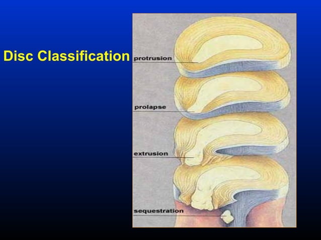 Nomenclature in spine mri | PPT