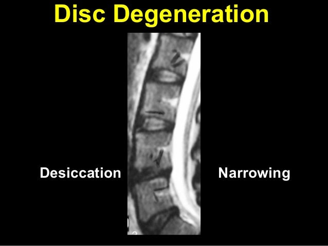 Nomenclature in spine mri