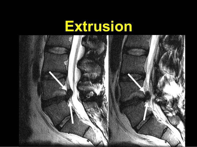 Nomenclature in spine mri