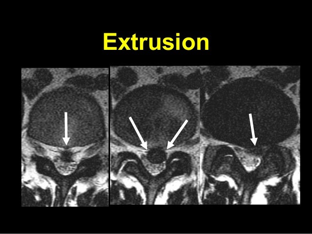 Nomenclature in spine mri