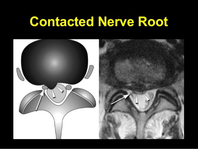Nomenclature in spine mri