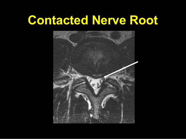 Nomenclature in spine mri