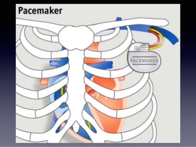 No more batteries: Heart-powered pacemaker could eliminate battery-re…