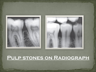 Non carious lesions of teeth | PPT