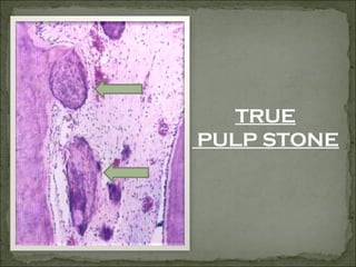 Non carious lesions of teeth | PPT