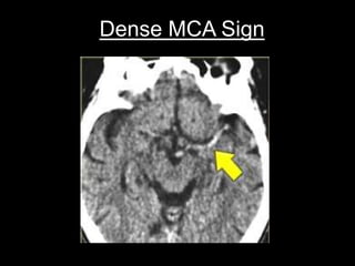 Non hemorrhagic ischemic stroke imaging | PPTX
