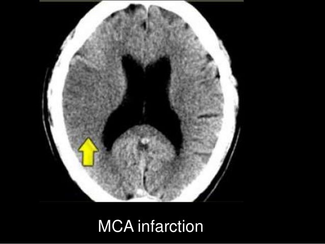 Non Hemorrhagic Ischemic Stroke Imaging