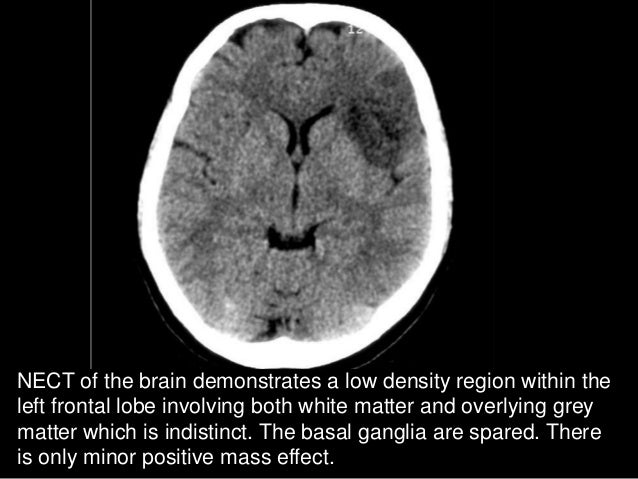 Non Hemorrhagic Ischemic Stroke Imaging