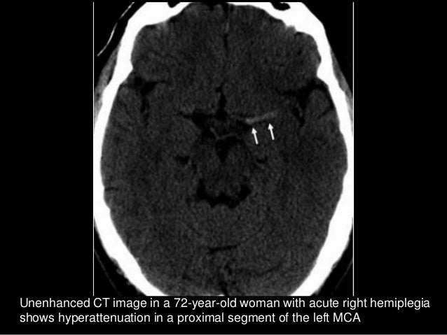 Non Hemorrhagic Ischemic Stroke Imaging