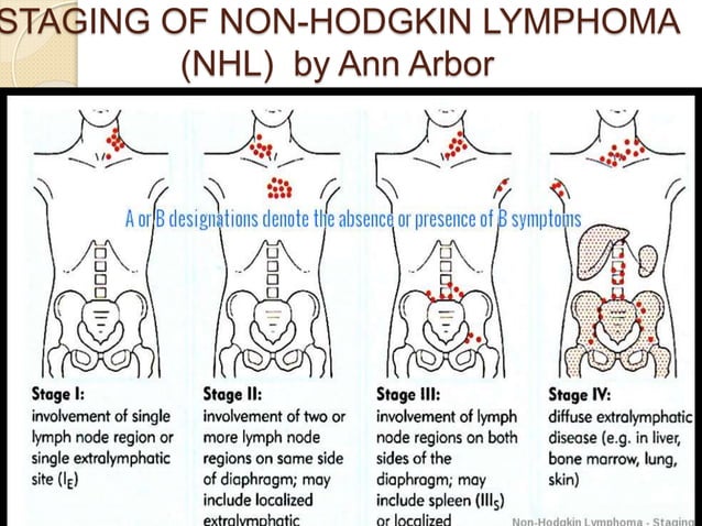 Non-Hodgkin lymphomas.pptx