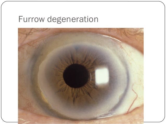 Non-Infectious keratitis