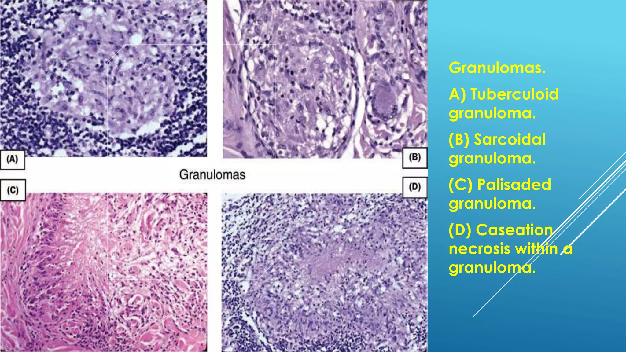 Non infectious&necrobiotic granulomatous diseases of the skin by M.Y ...