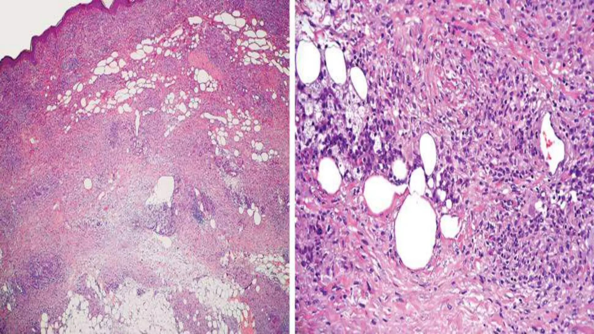 Non infectious&necrobiotic granulomatous diseases of the skin by M.Y ...
