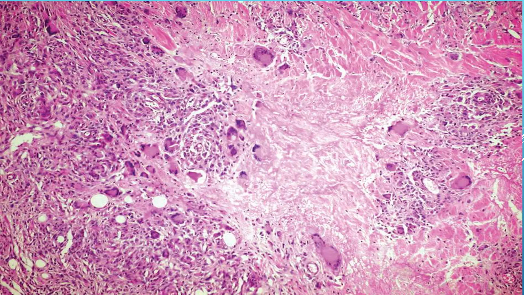 Non infectious&necrobiotic granulomatous diseases of the skin by M.Y ...