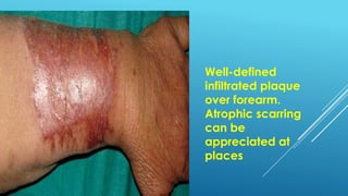 Non infectious&necrobiotic granulomatous diseases of the skin by M.Y ...