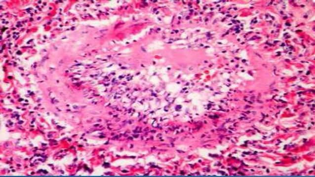 Non infectious&necrobiotic granulomatous diseases of the skin by M.Y ...