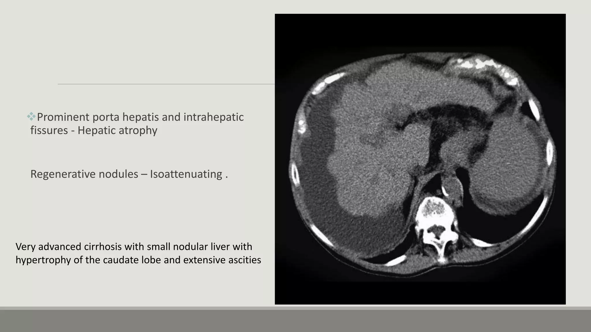Imaging of portal hypertension | PPTX