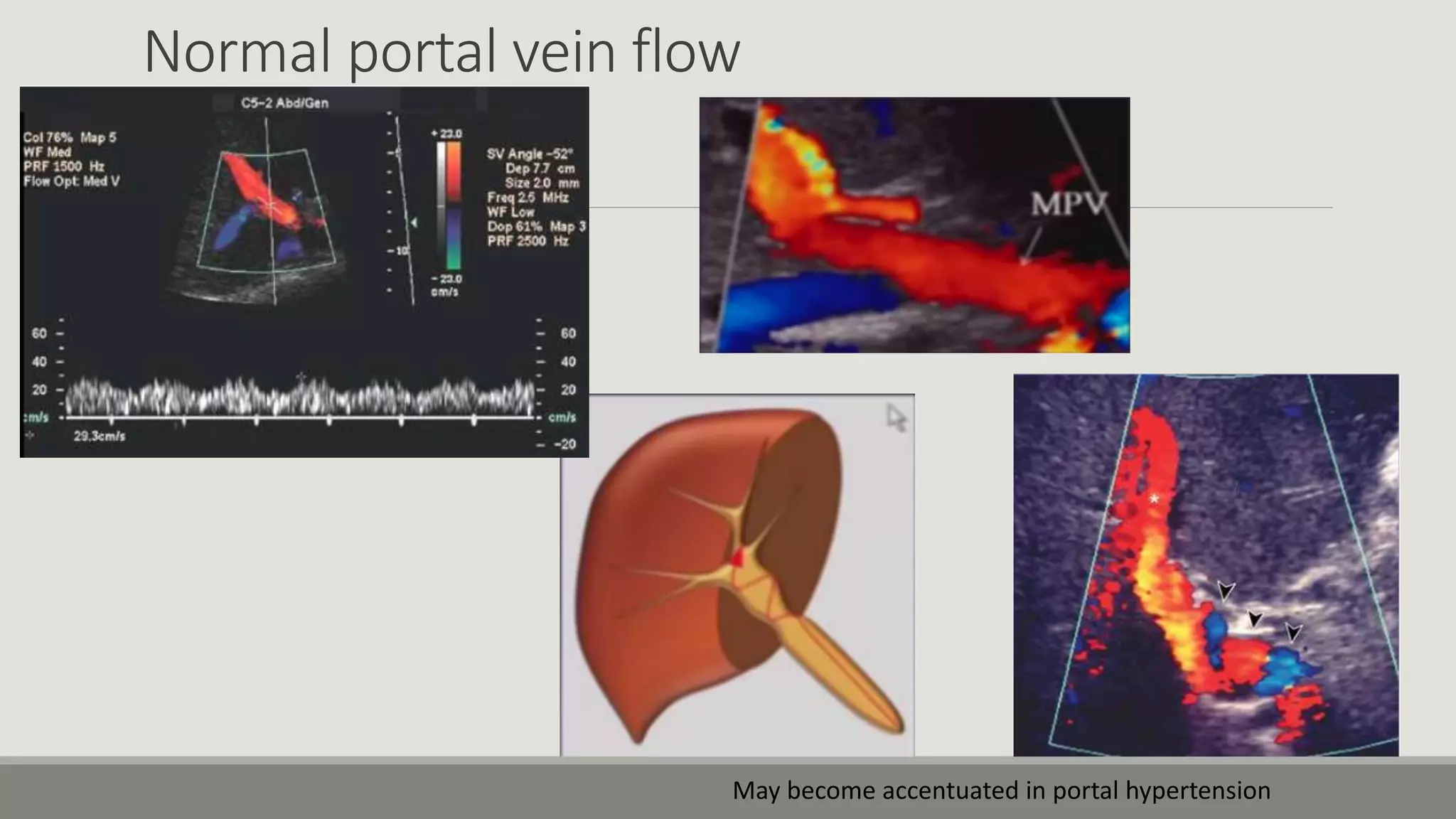 Imaging of portal hypertension | PPTX