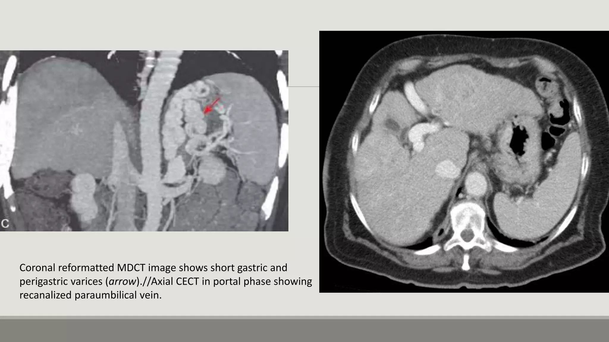 Imaging of portal hypertension | PPTX