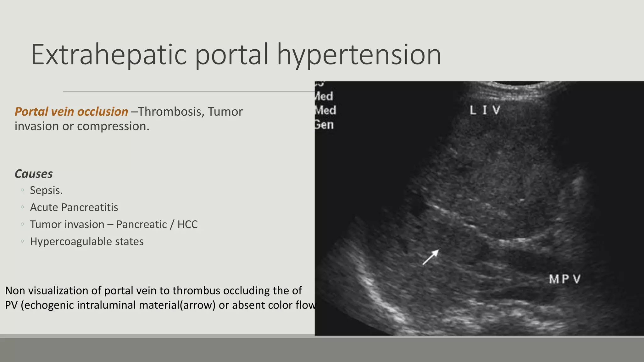 Imaging of portal hypertension | PPTX