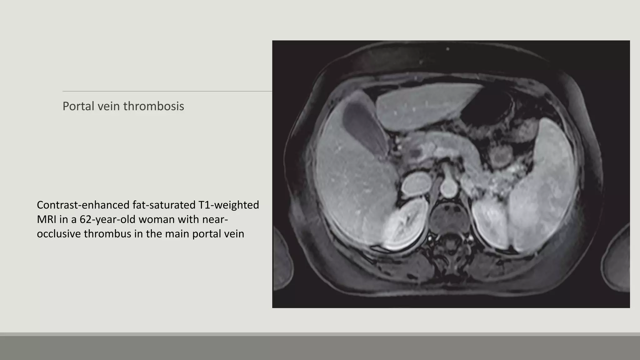 Imaging of portal hypertension | PPTX