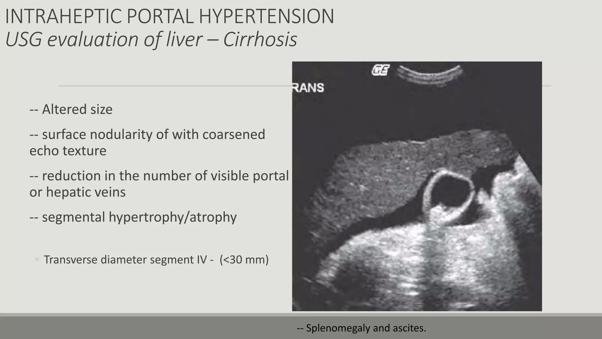 Imaging of portal hypertension | PPTX