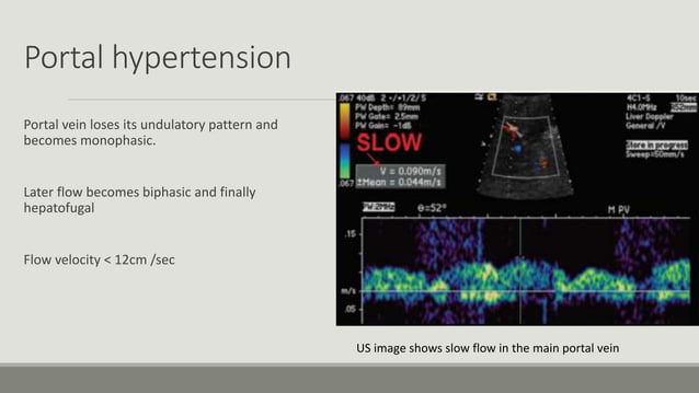 Imaging of portal hypertension | PPTX | Blood Disorders | Diseases and ...