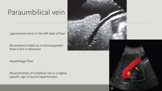 Imaging of portal hypertension | PPTX