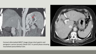 Imaging of portal hypertension | PPTX