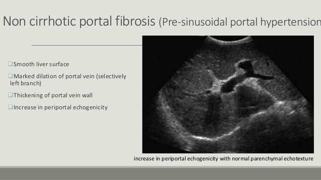Imaging of portal hypertension