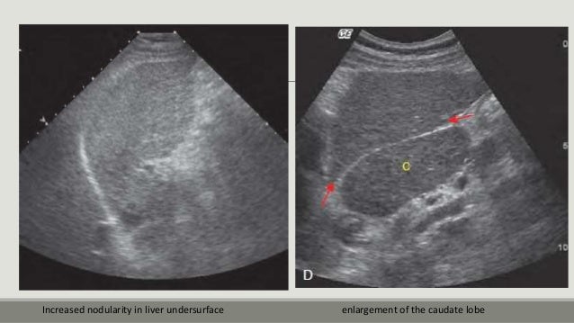Imaging of portal hypertension