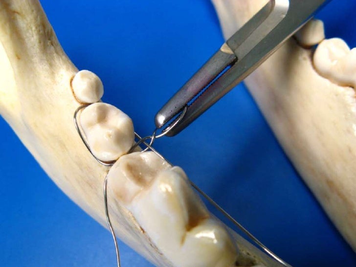 Veterinary Dentistry - Non Invasive Mandibular Fracture Repair in Dog…