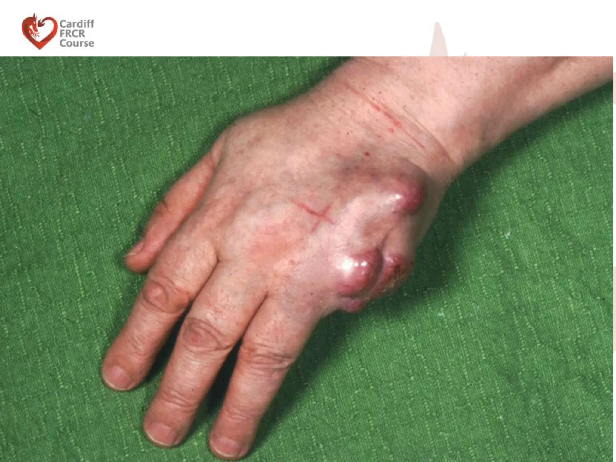 Non Melanoma Skin Cancer Management Diagnosispdf