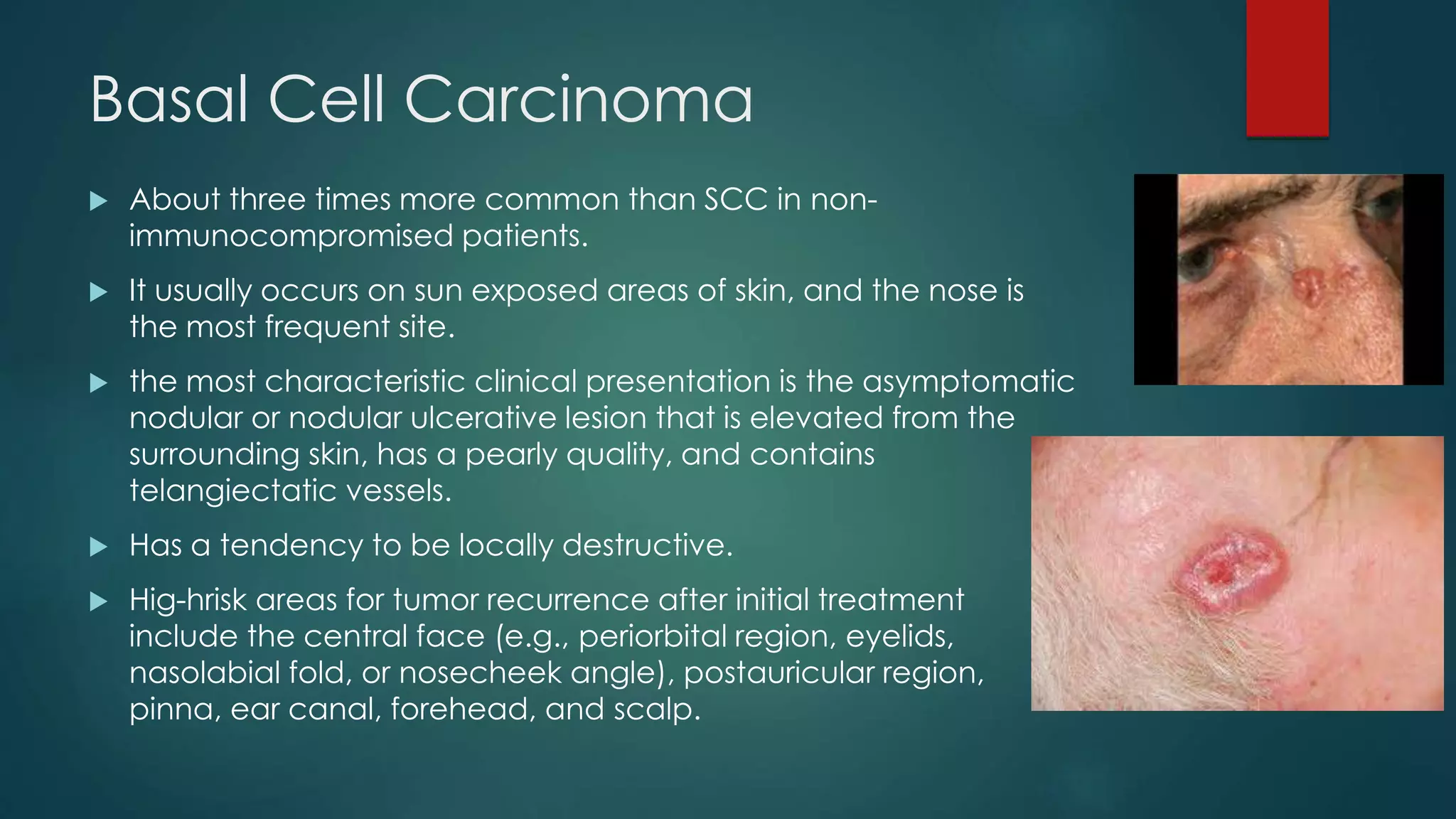 Non-melanoma skin cancer | PDF