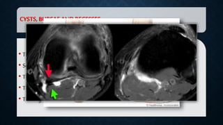 Radiological study of non meniscal knee joint pathology by dr ...