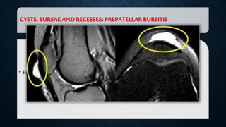 Radiological study of non meniscal knee joint pathology by dr ...