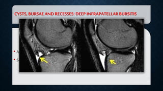 Radiological study of non meniscal knee joint pathology by dr ...