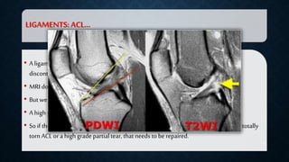 Radiological study of non meniscal knee joint pathology by dr ...