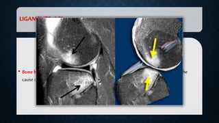 Radiological study of non meniscal knee joint pathology by dr ...
