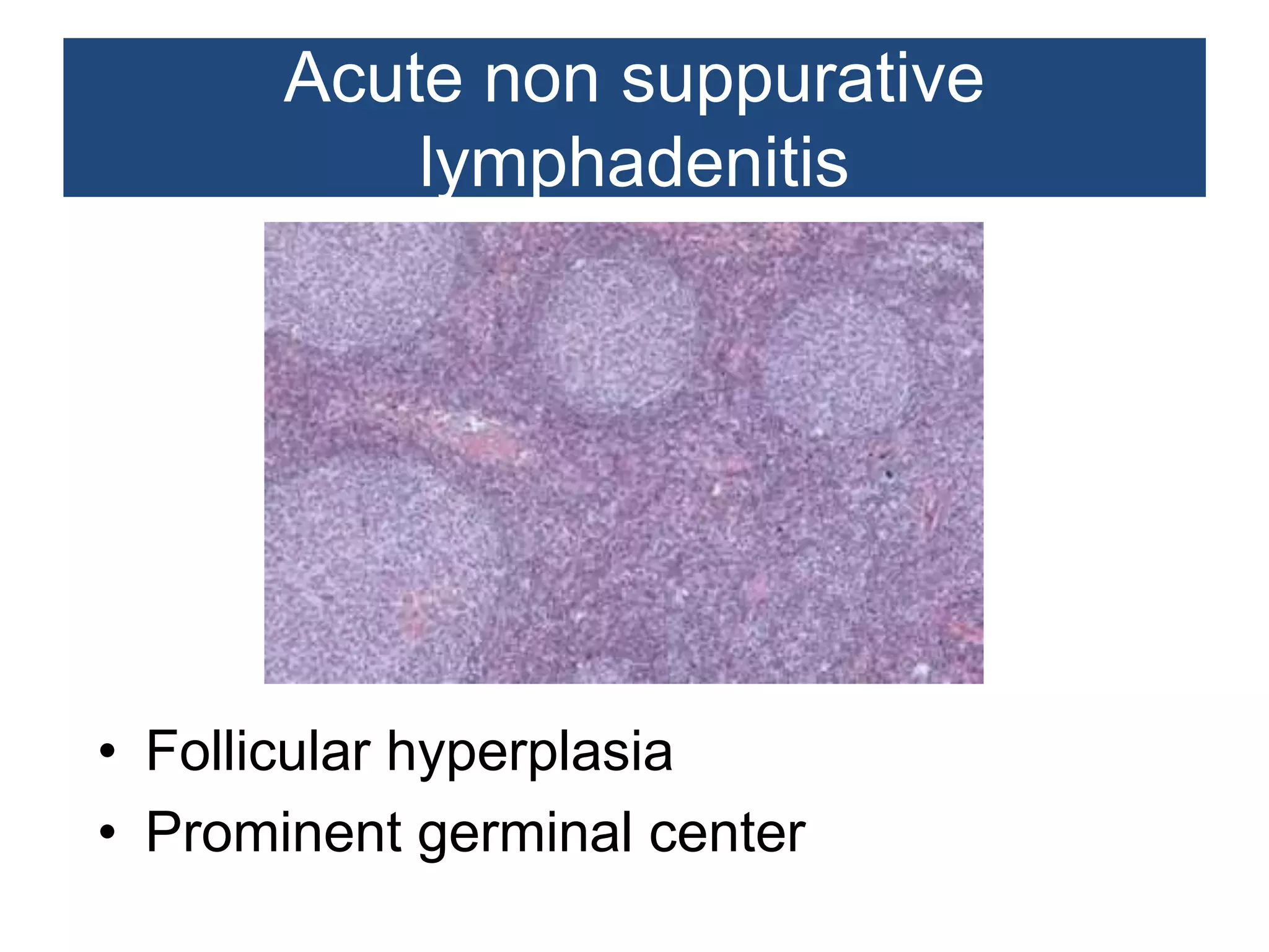 Non neoplastic lesions of lymph node | PPTX