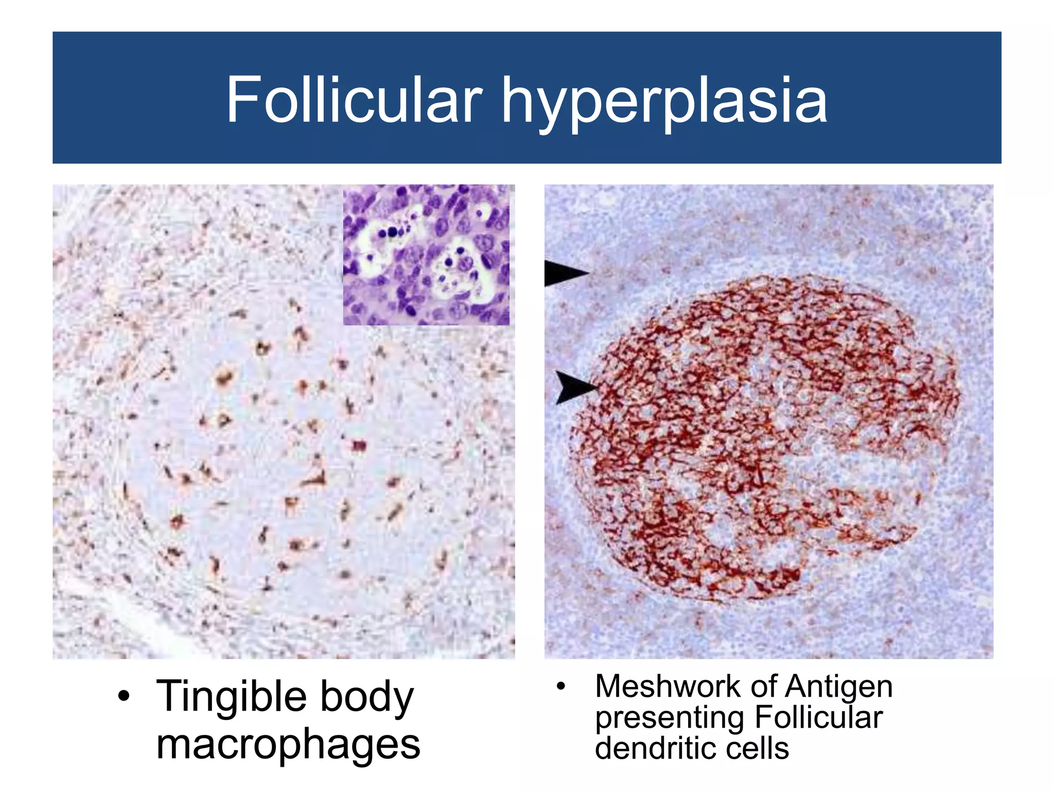 Non neoplastic lesions of lymph node | PPTX