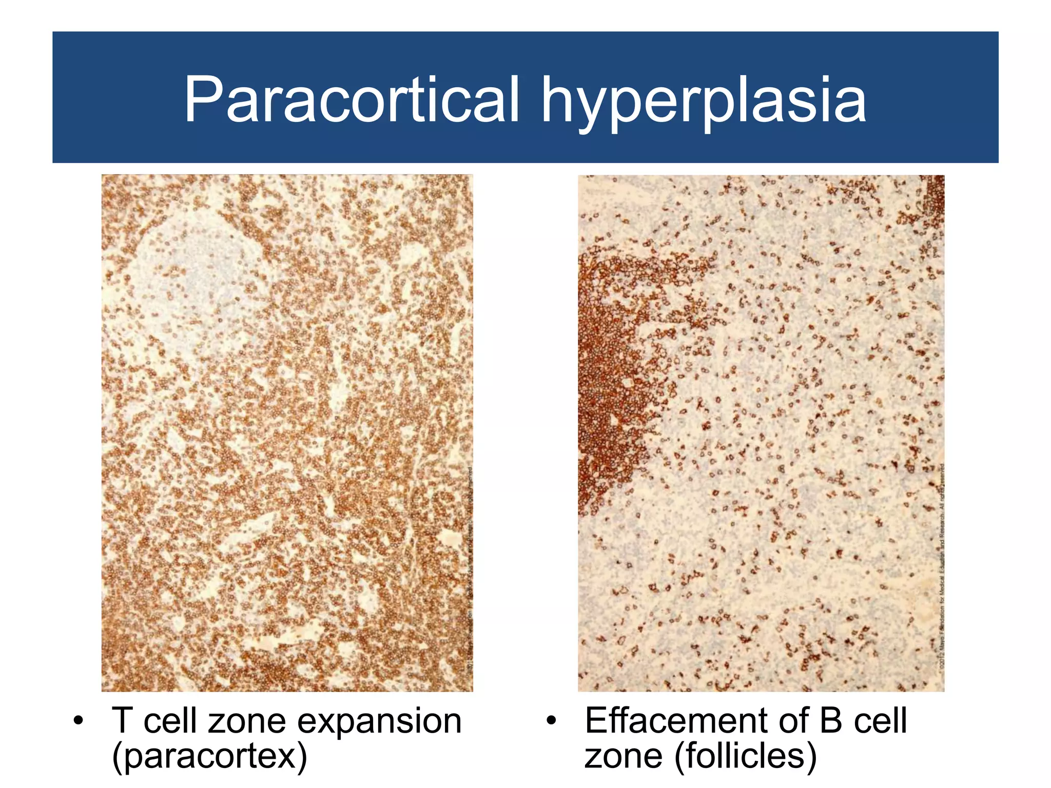 Non neoplastic lesions of lymph node | PPTX