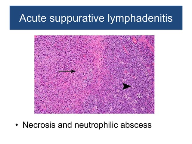 Non neoplastic lesions of lymph node | PPTX | Blood Disorders ...