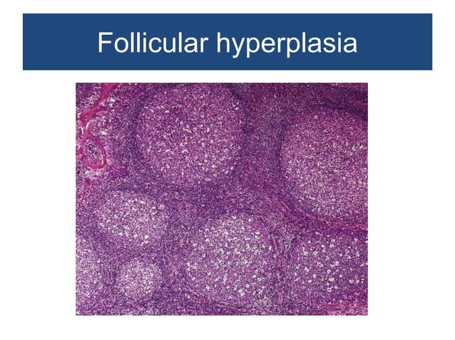 Non neoplastic lesions of lymph node | PPTX | Blood Disorders ...